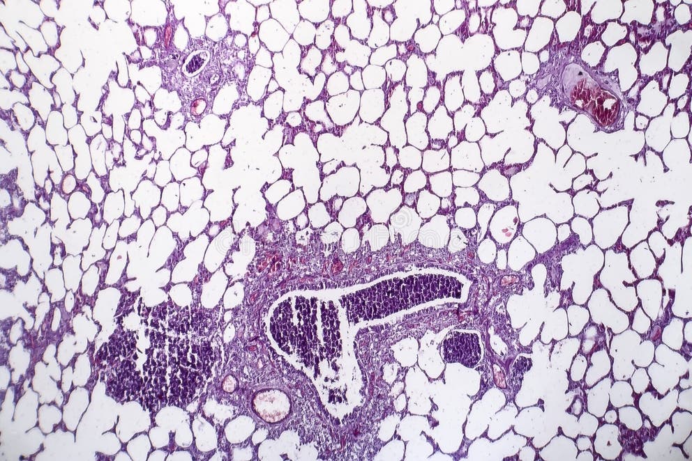 Pneumonia, Light Micrograph Stock Photo - Image of microorganism ...