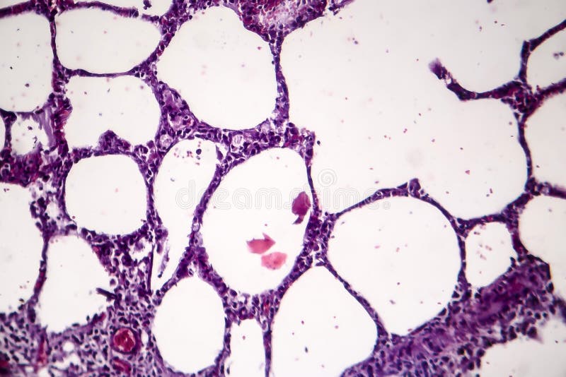 Pneumonia, Light Micrograph Stock Photo - Image of micro, inhalation ...