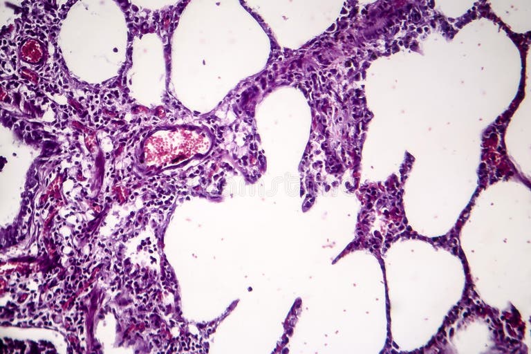 Pneumonia, Light Micrograph Stock Photo - Image of alveolus, inhalation ...