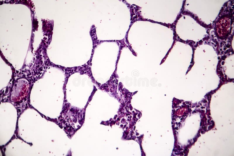 Pneumonia, Light Micrograph Stock Image - Image of medicine, histology ...