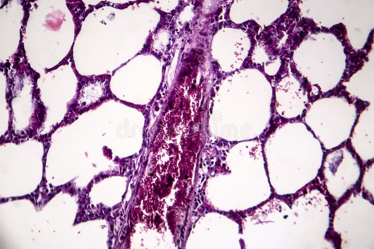 Pneumonia, Light Micrograph Stock Image - Image of alveolar, aspiration ...