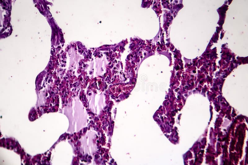 Pneumonia, Light Micrograph Stock Image - Image of alveolar, aspiration ...