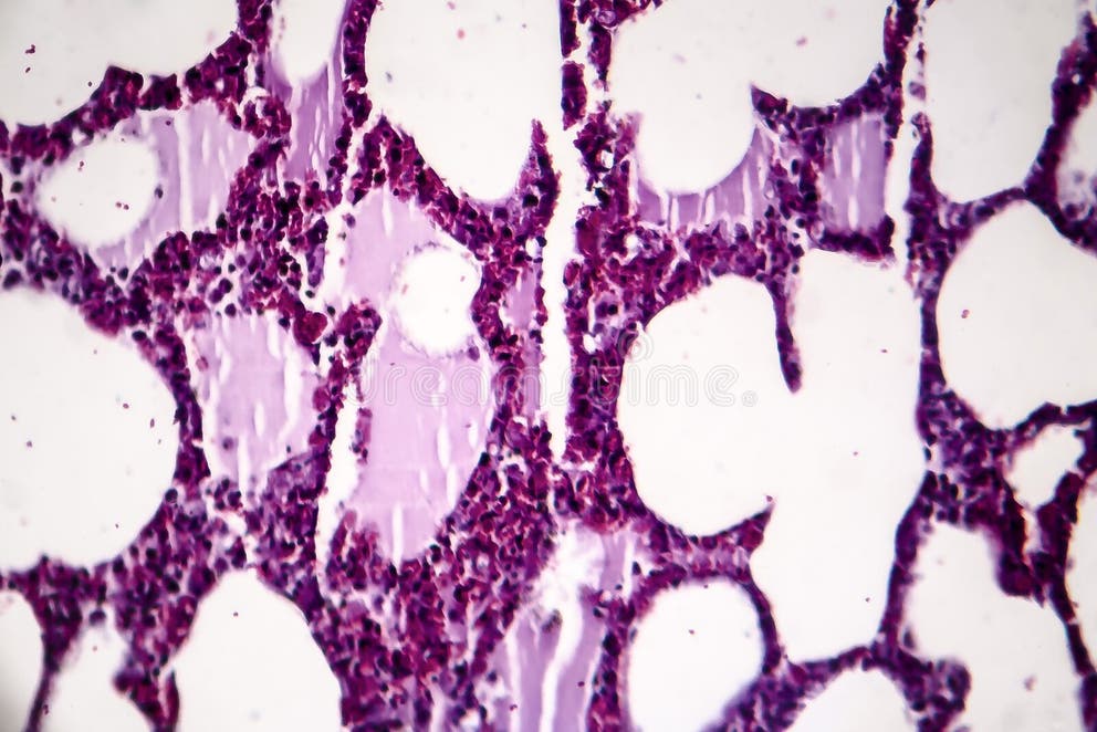 Pneumonia, Light Micrograph Stock Photo - Image of morphological ...