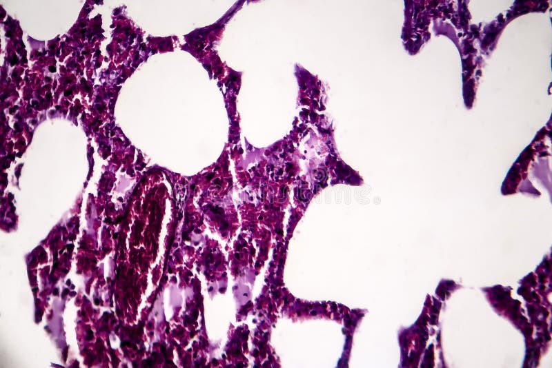 Pneumonia, Light Micrograph Stock Image - Image of micro, alveolar ...