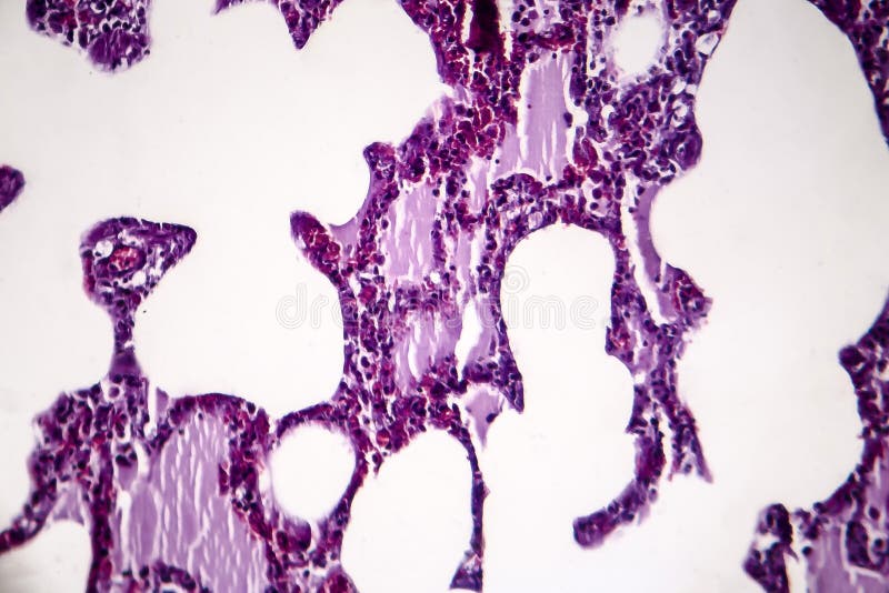Pneumonia, Light Micrograph Stock Image - Image of histology ...