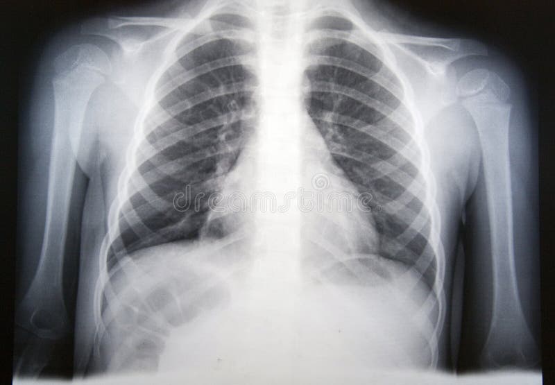 Pneumonie photo stock. Image du coffre, laboratoire, contrôle - 15318390