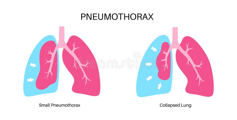 Pneumothorax Diagram Stock Illustrations – 103 Pneumothorax Diagram ...
