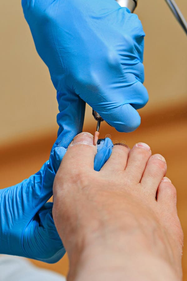 Podiatrie photo stock. Image du écaillement, caucasien - 45002524