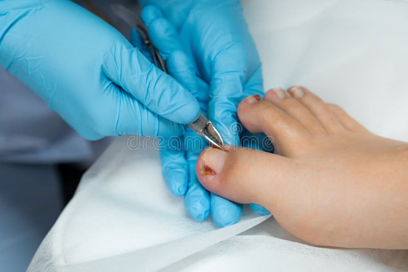 A Podiatrist Performs the Procedure of Ingrown Nail Removal Using ...