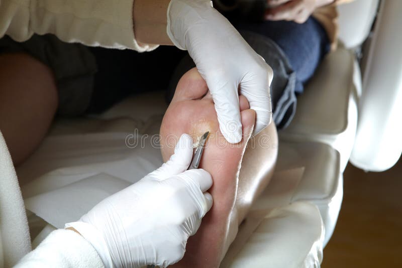 A Podiatrist Works with a Scalpel Stock Image - Image of humen ...