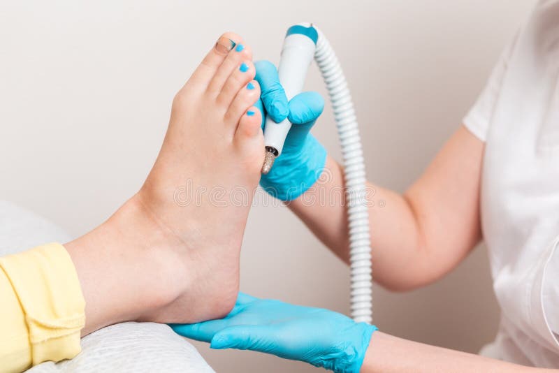 Podologist Does a Hardware Peeling of the Foot. Close-up Stock Image ...