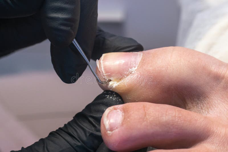 Podologist Uses a Curette To Remove a Callus on the Toe Stock Image ...