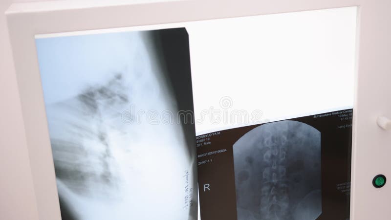 Pointing Finger, Spinal Radiography, Diagnostic Imaging Stock Footage ...