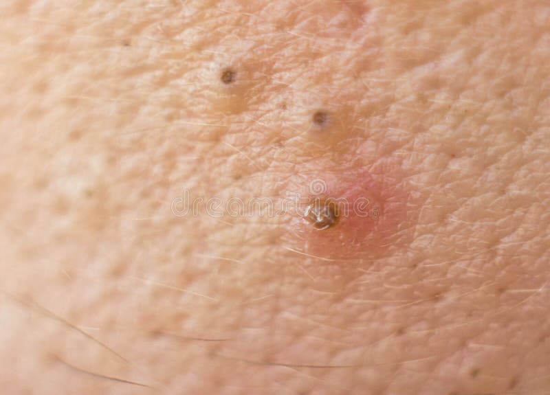 Points Noirs Sur Le Macro De Visage Et De Boutons, Point Noir Image ...