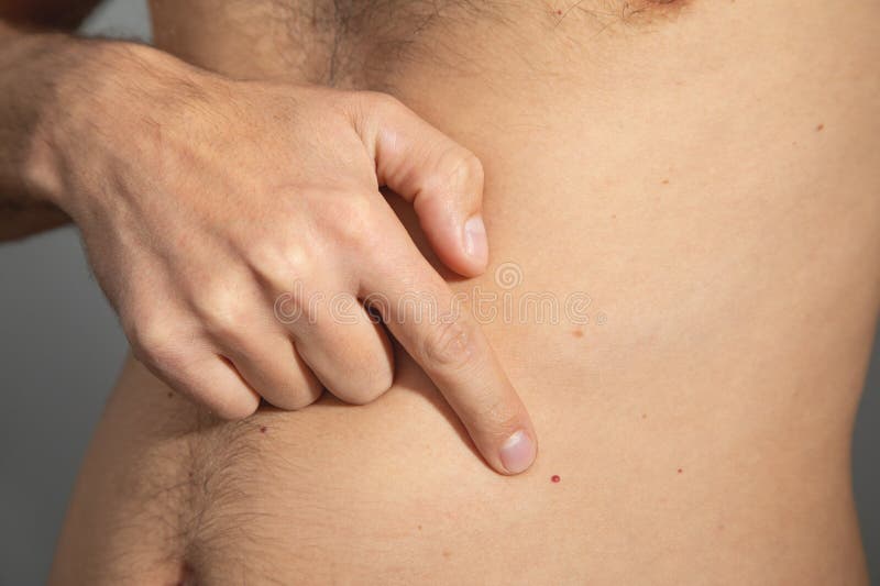 Points Rouges Sur Le Corps Humain Photo stock - Image du fermer, points ...