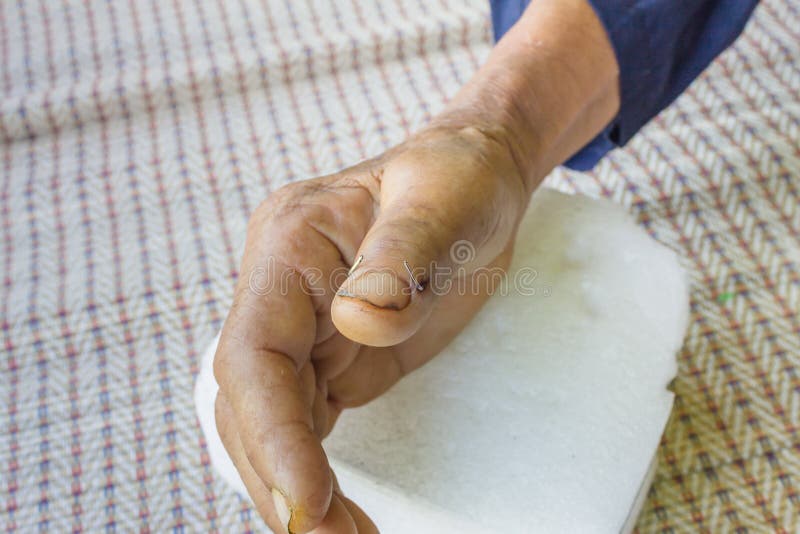 Osso Fratturato E Fasciatura Del Pollice Per Immobilizzare Il Dito ...