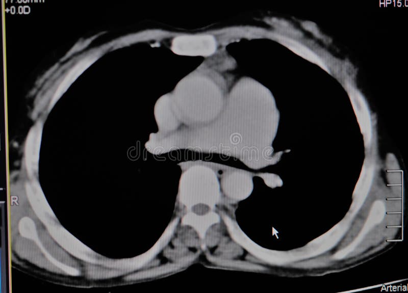 Polmone CT fotografia stock. Immagine di esame, tosse - 83533272