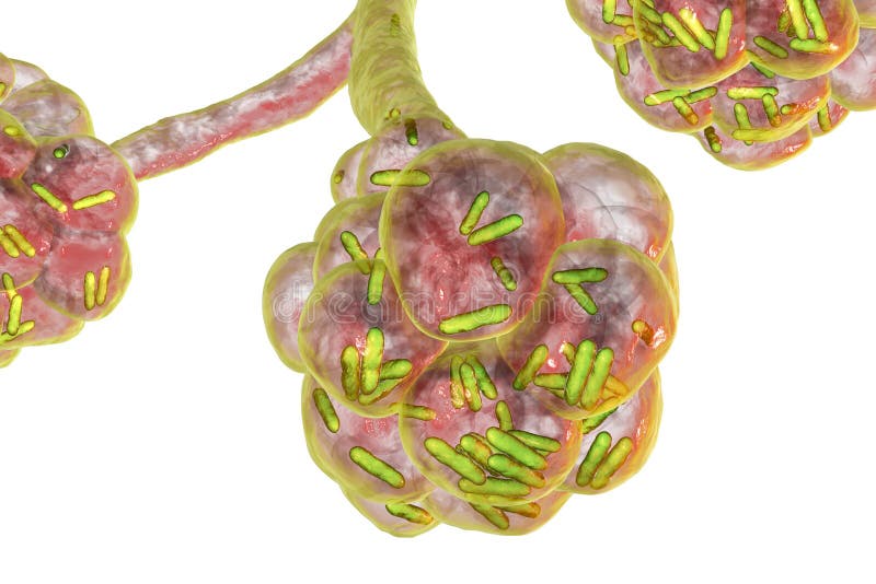 Polmonite Batterica, Concetto Medico Illustrazione di Stock ...