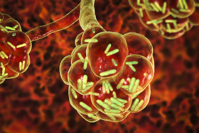 Polmonite Batterica, Concetto Medico Illustrazione di Stock ...