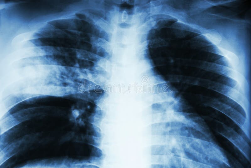 Polmonite lobare immagine stock. Immagine di cassa, alveolo - 81146167