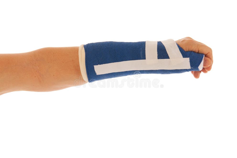 Polso rotto in gesso fotografia stock. Immagine di adulto - 30551006