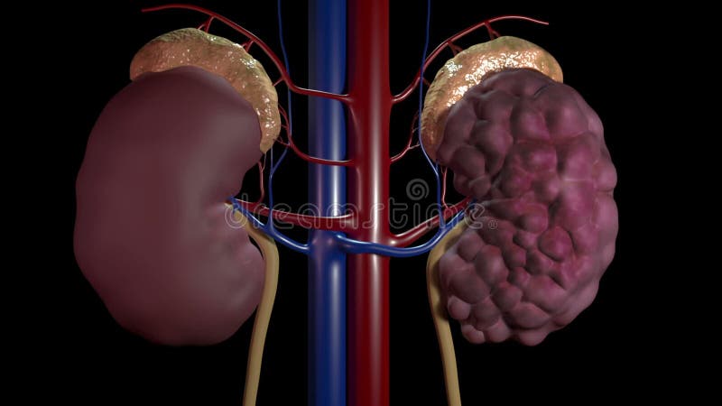 Polycystic Kidney Disease is a Disease in Which Clusters of Cysts ...