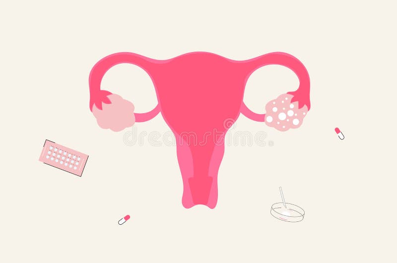 Pcos Or Polycystic Ovary Syndrome Symptoms Stock Vector Illustration