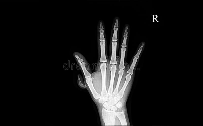 Polydaktylie stockbild. Bild von polydaktylie - 43314411