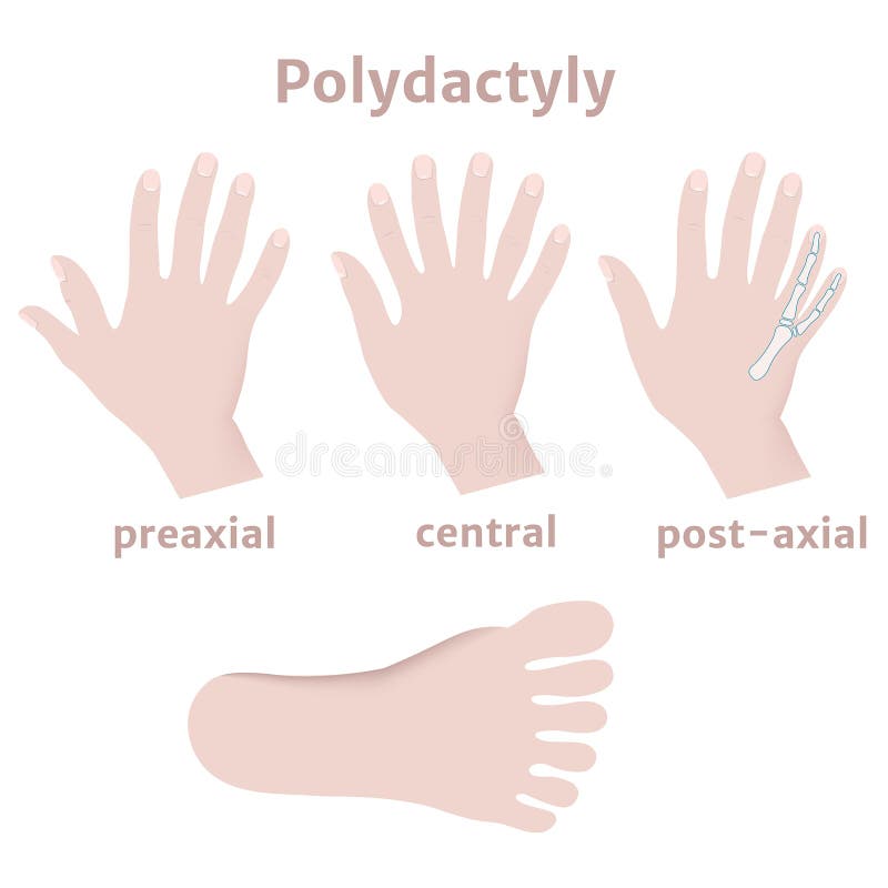 Polydactyly Illustration Stock Illustrations – 7 Polydactyly ...