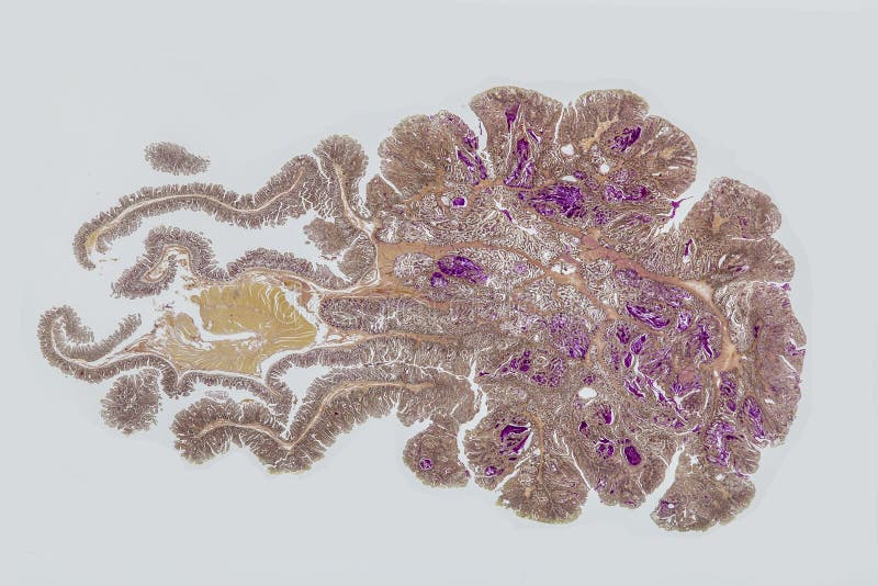 Colon polyp stock photo. Image of intestine, tissue - 196758274