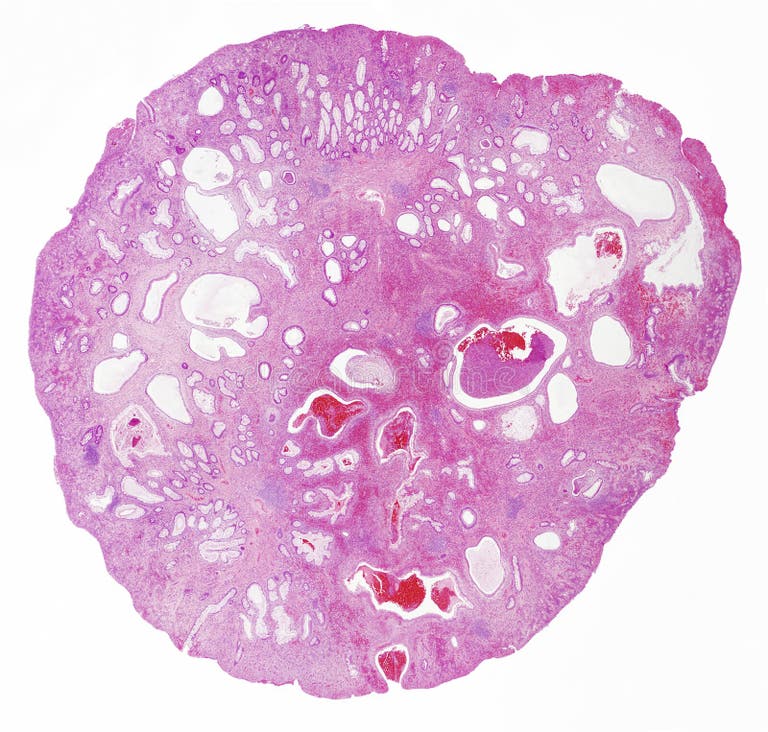 Polype du côlon photo stock. Image du intestin, médecine - 18130784