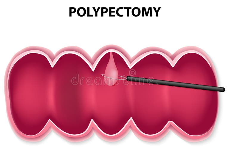 Removal Polyp Stock Illustrations – 111 Removal Polyp Stock ...