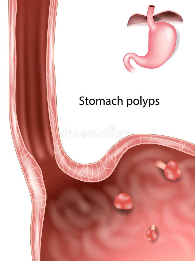 Polyps in Stomach. Gastric Polyp Stock Vector - Illustration of ...