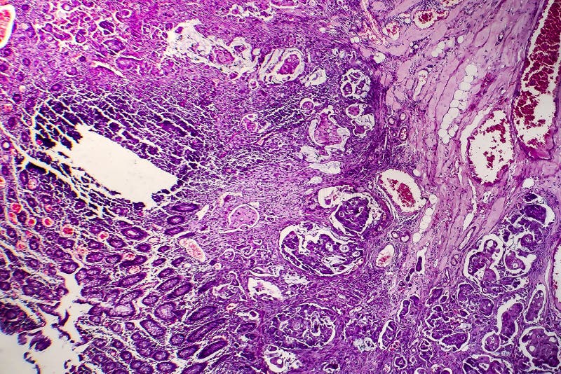 Poorly Differentiated Intestinal Adenocarcinoma , Light Micrograph ...