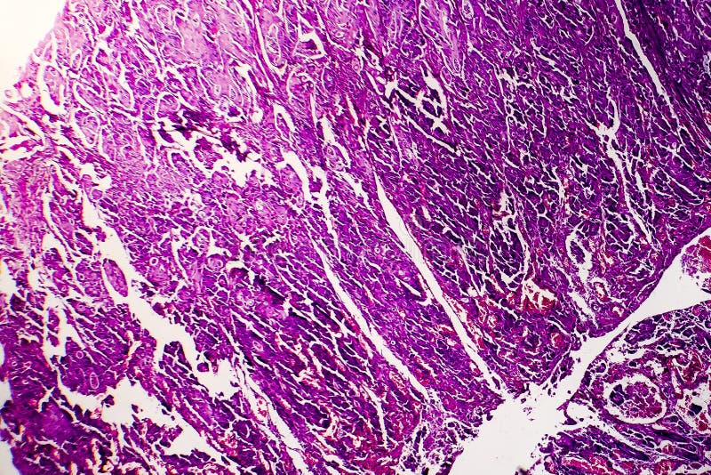 Poorly Differentiated Intestinal Adenocarcinoma , Light Micrograph ...