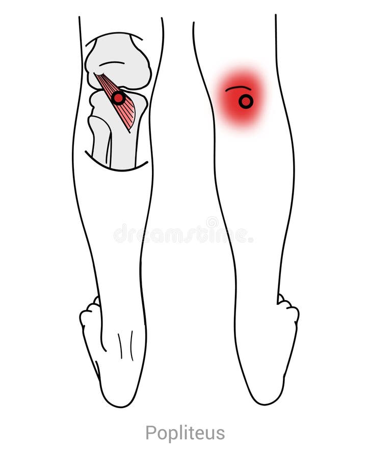 Popliteus Myofascial Trigger Points Cause Pain at the Back of the Knee ...