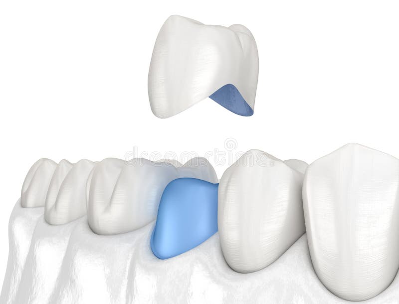 Porcelain Crown Placement Over Premolar Tooth. Medically Accurate 3D ...