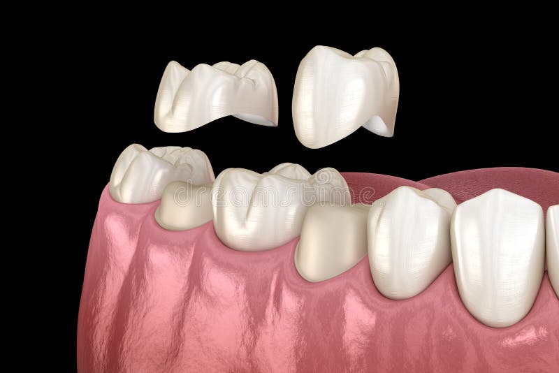 Porcelain Crowns Placement Over Premolar and Molar Teeth. Medically ...