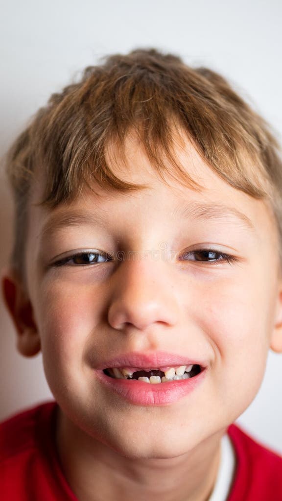 Portrait of a Boy with Bad Teeth, Fallen Front Upper Teeth Stock Image ...