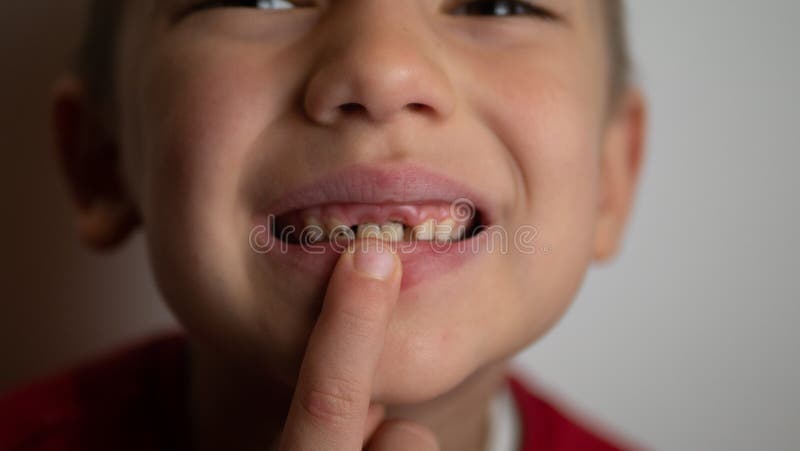 Portrait of a Boy with Bad Teeth, Fallen Front Upper Teeth Stock Image ...