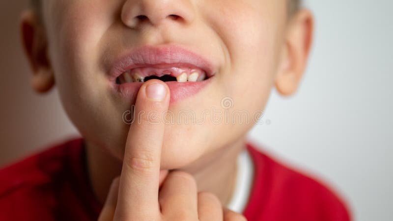 Portrait of a Boy with Bad Teeth, Fallen Front Upper Teeth Stock Image ...