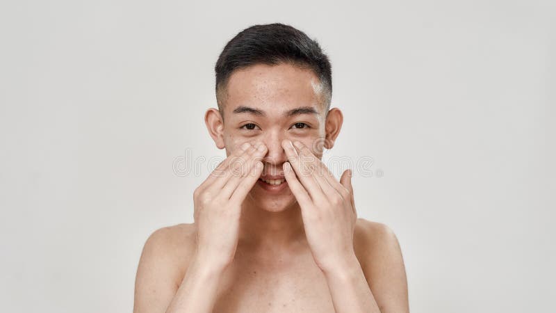 Portrait of Young Asian Man with Problematic Skin and Hyperpigmentation ...