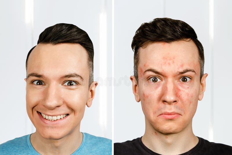 Portrait of Young Guy with Allergy, with Red Face. Man before - after ...