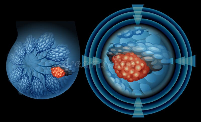 Breast Cancer Diagram In Detail Stock Vector - Illustration of biology ...