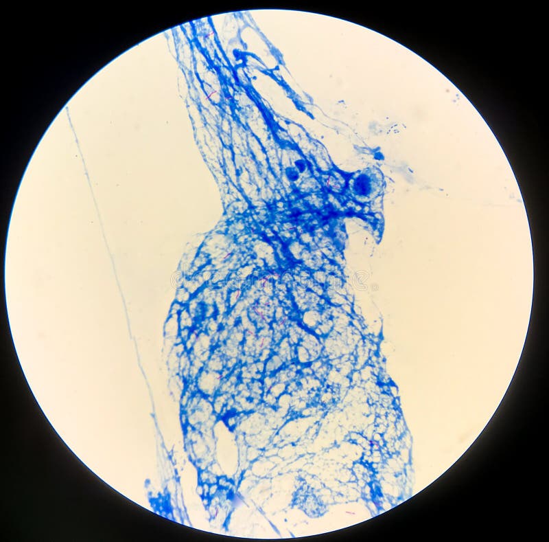 Acid Fast Bacilli Positive Red Cells. Stock Image - Image of microscopy ...