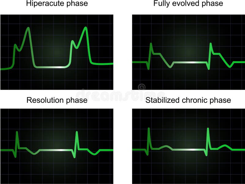 ECG of Evolution ( Step by Step ) of STEMI Stock Vector - Illustration ...