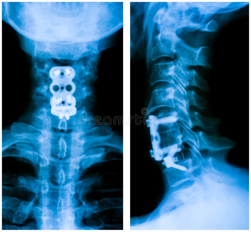 Post Op Ray Cervical Spine Photos - Free & Royalty-Free Stock Photos ...