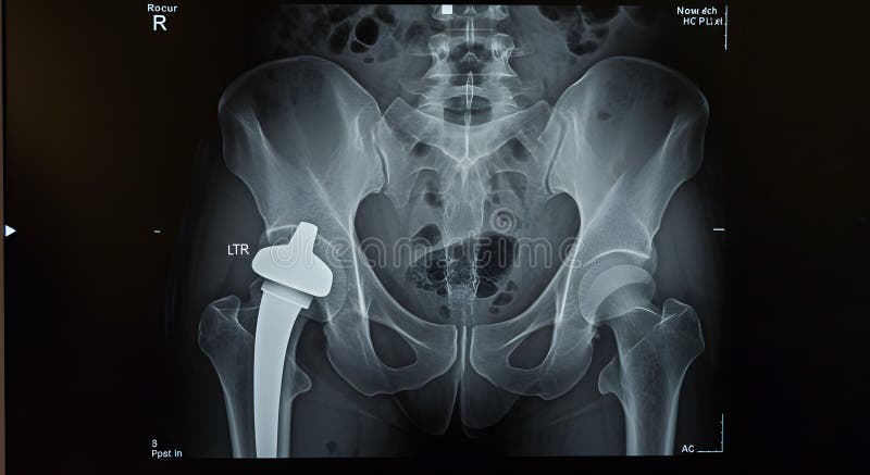 Post-Operative Hip Replacement X-Ray Imaging: Assessment of Prosthesis ...