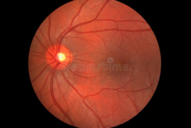 Posterior Pole stock image. Image of disc, armd, macular - 4235339