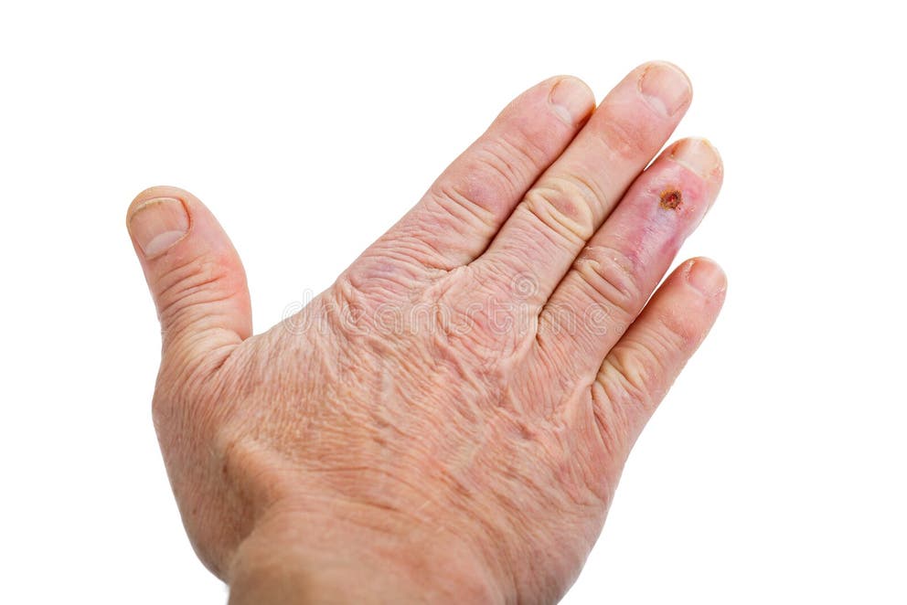 Postoperative Scar on the Fourth Finger Stock Photo - Image of care ...